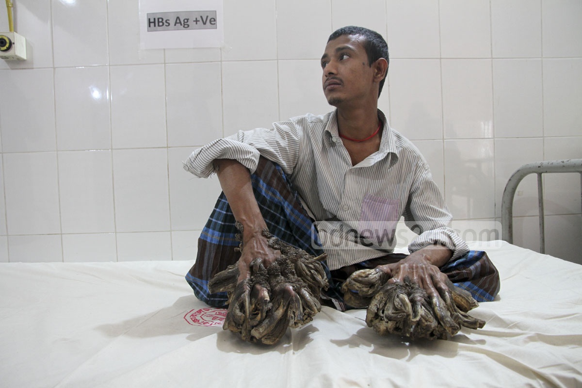 Warts removed from left hand of ‘Tree Man’