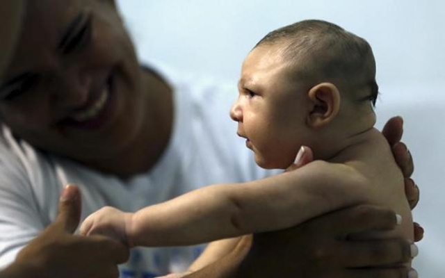 Confirmation that Zika causes microcephaly shifts debate to prevention